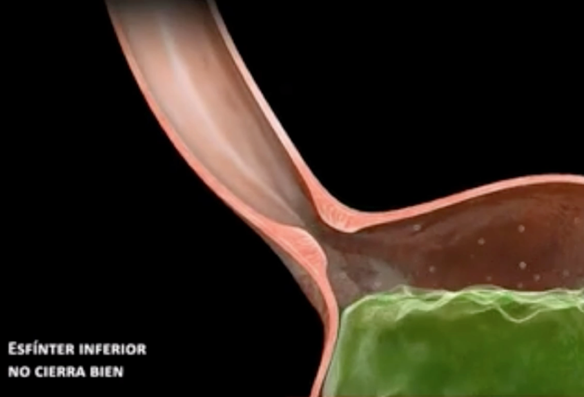 ¿Qué es la manometría esofágica de alta resolución?: Información para ...