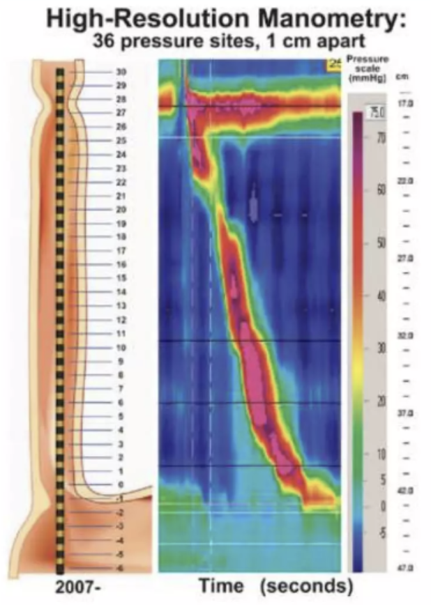 ¿Qué es la manometría esofágica de alta resolución?: Información para ...